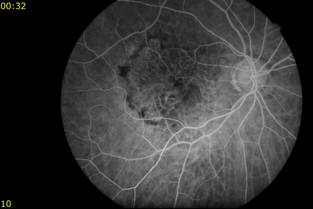 ARMD with CNV 2 - Fundus Photo