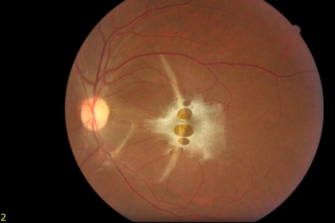 Traumatic Epiretinal Membrane with double choroidal rupture 1 (1 ...